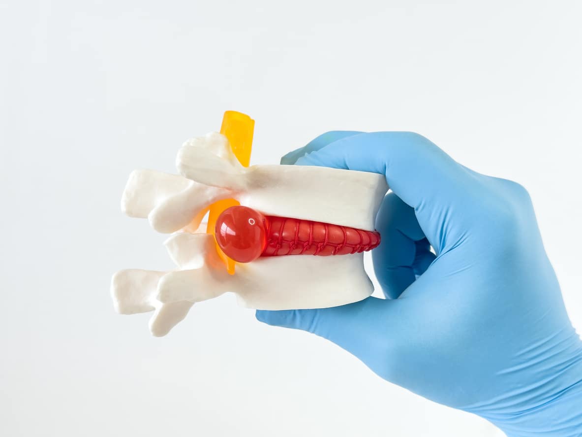 Herniated Cervical Disc Treatment in NJ | NU-Spine