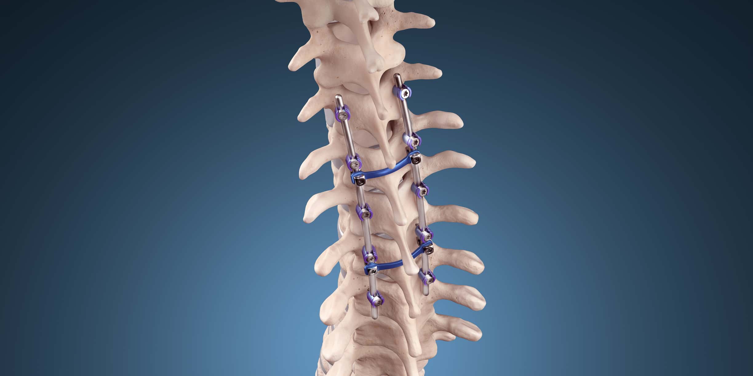 Introduction to Complex Spinal Reconstruction Surgery
