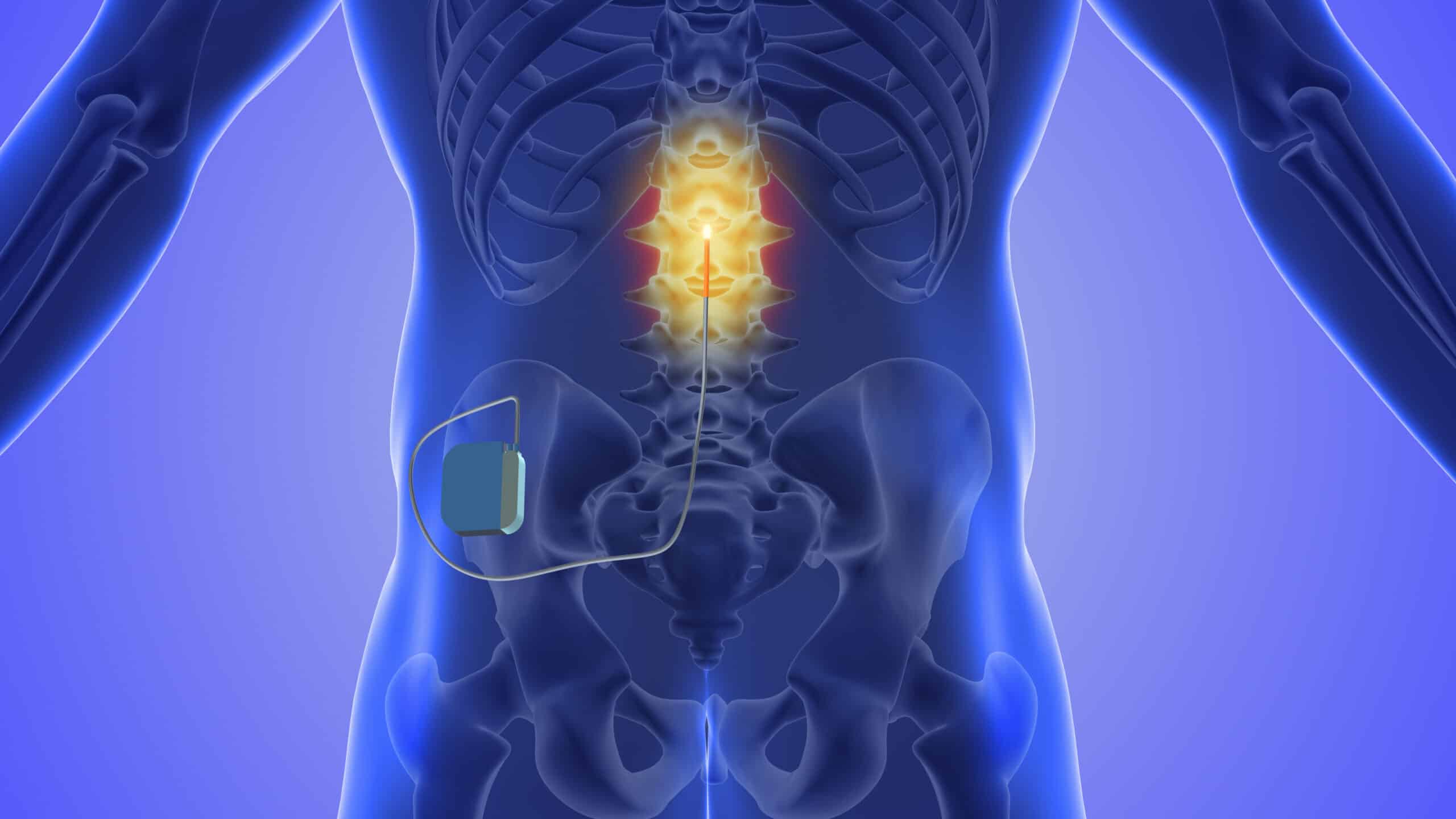 What to Expect from a Spinal Cord Stimulator Implant Trial